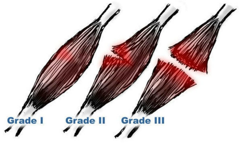 Hamstring Verrekking: Eerste Hulp en Behandeling