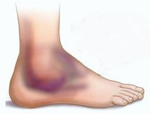 Enkel Verzwikt? Ontdek de Beste Tips voor Snel Herstel!